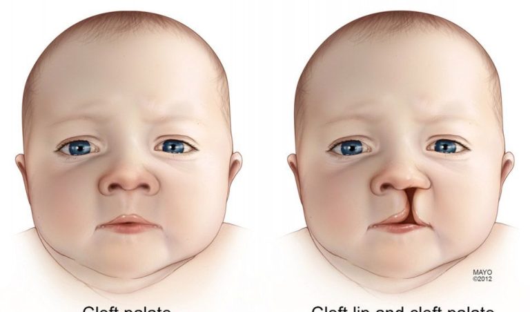 El labio leporino: un defecto de nacimiento que puede ser corregido ...